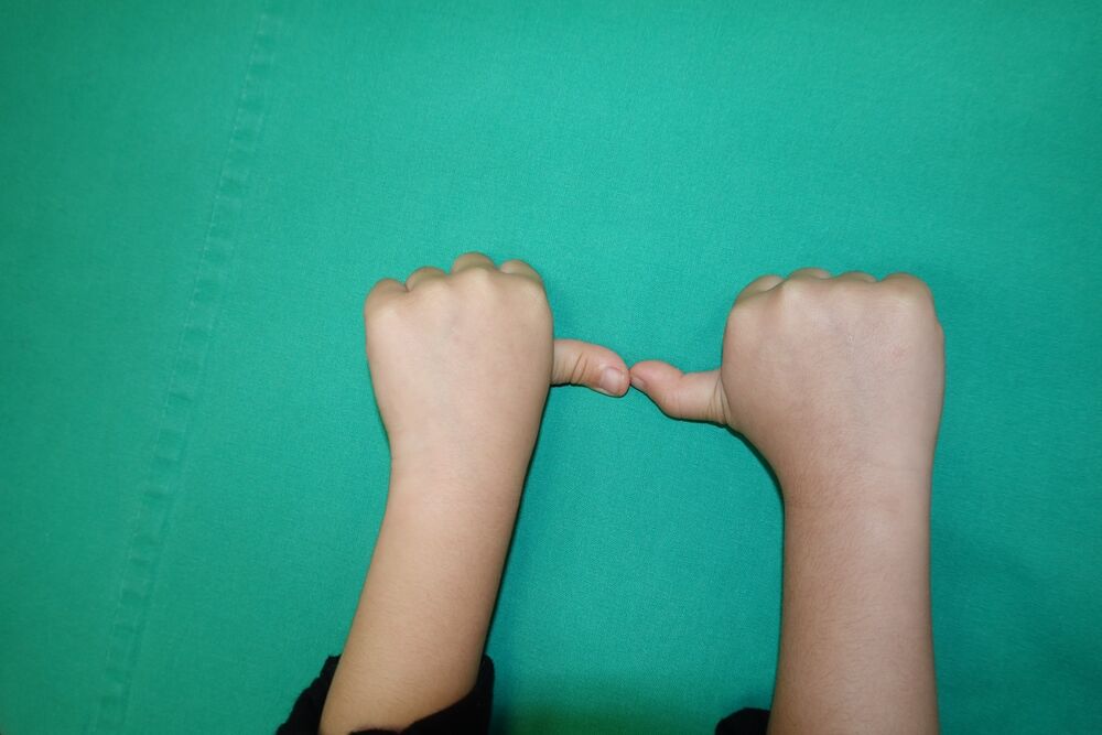兒童板機拇指 (pediatric trigger thumb)-手外科醫師醫療網